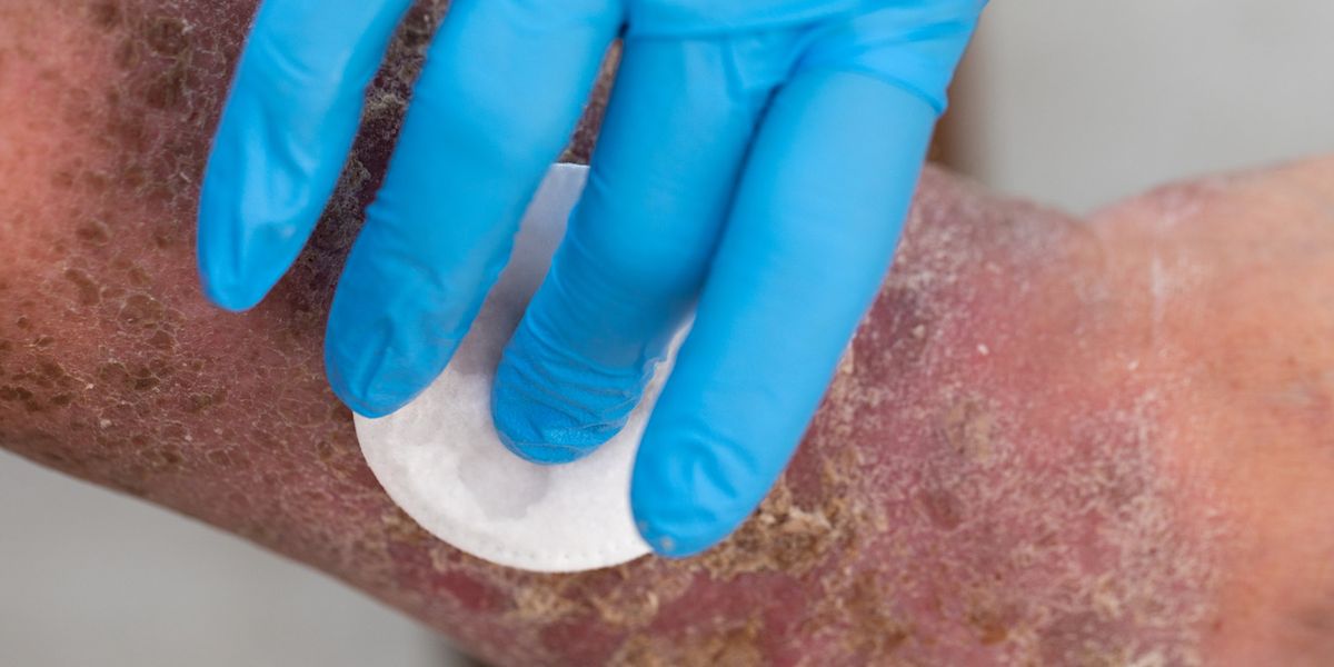 Developing Skills in Leg Ulcer Management - 3 Day Course, Leatherhead ...