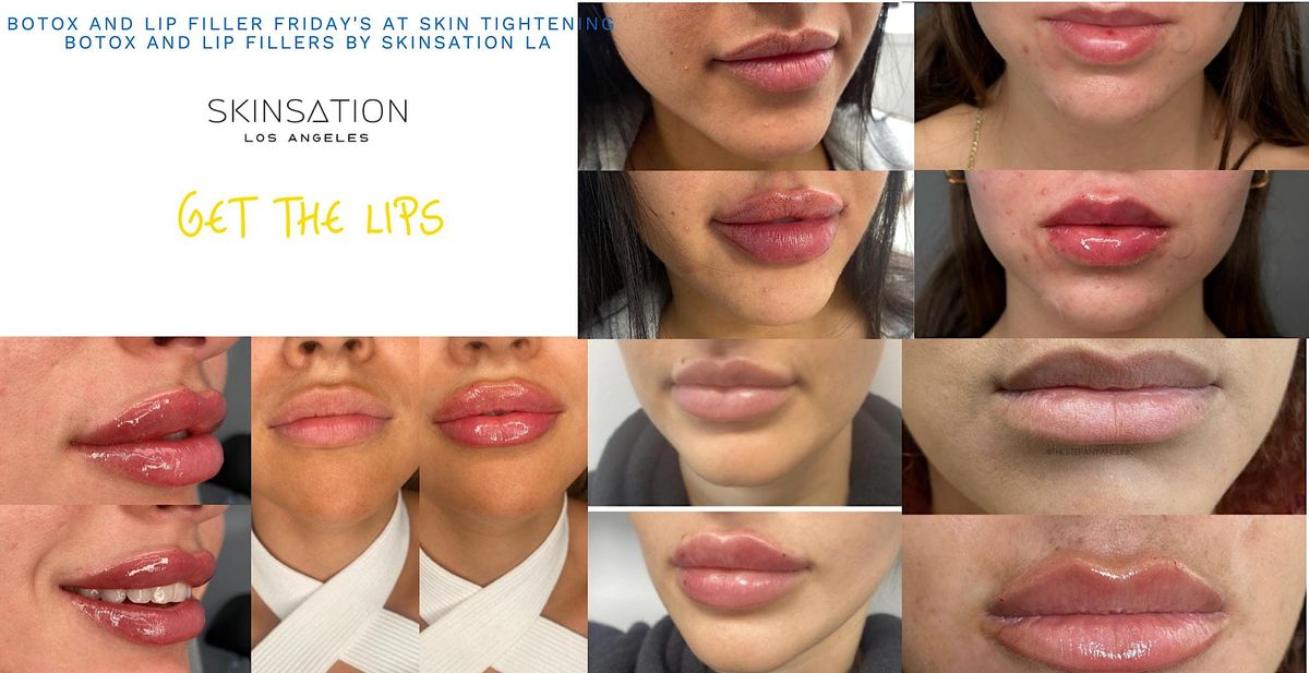 Lip Filler and Botox Fridays at our Medical spa in Los Angeles ...