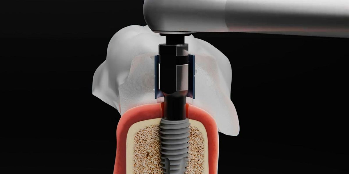 Guided Implant Placement with Hands-on I Stockton, CA, Hilton Stockton ...