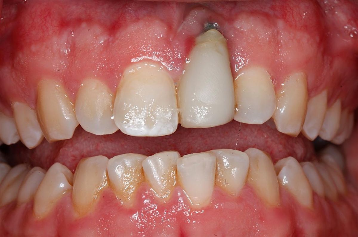 Mastering GBR, Implant Complications & Post-Op Care, Maggiano's Little ...