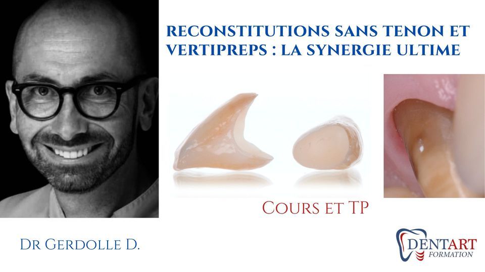 Reconstitutions corono-radiculaires sans tenon et verti-preps : la ...